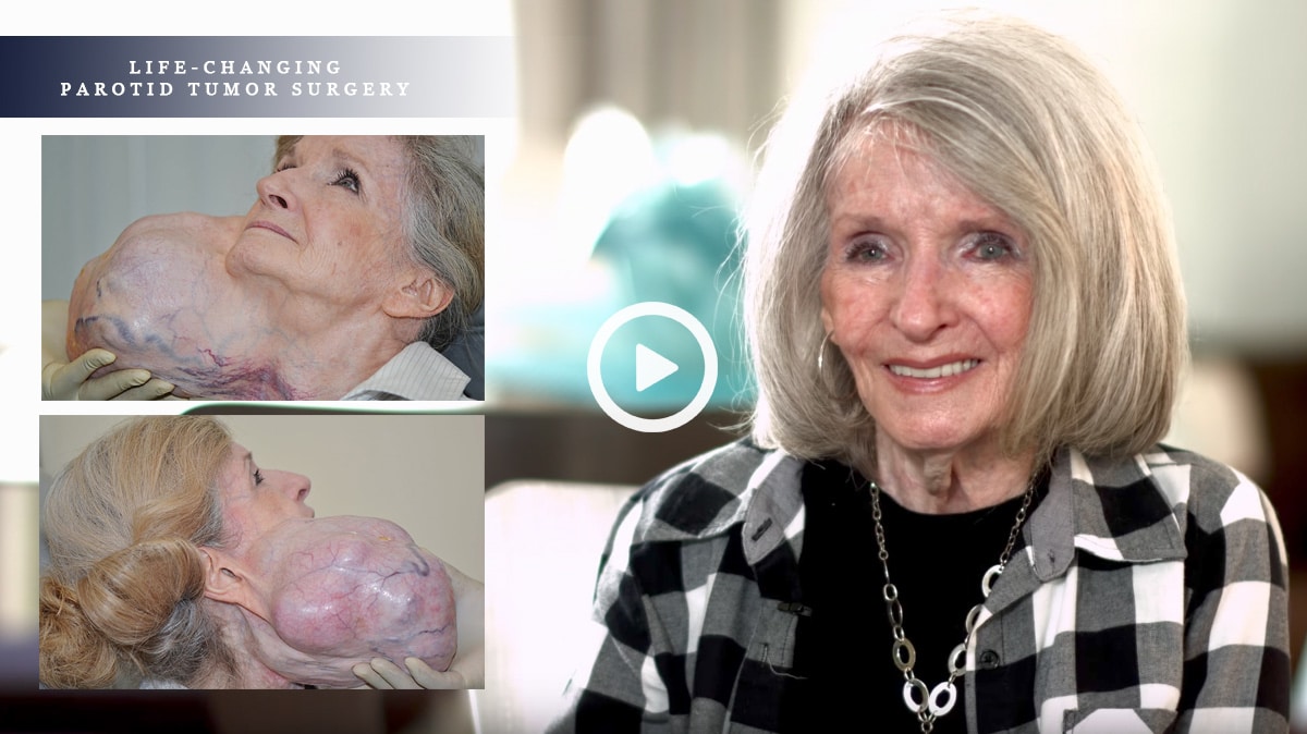 Parotid Gland Tumor Removal