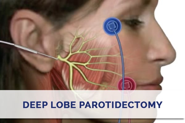 Parotid Gland Tumor & Salivary Stone Surgeons, Los Angeles CA