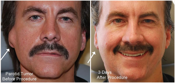 parotid-tumor-removal-surgery - Parotid Tumor Surgery | Salivary Gland ...